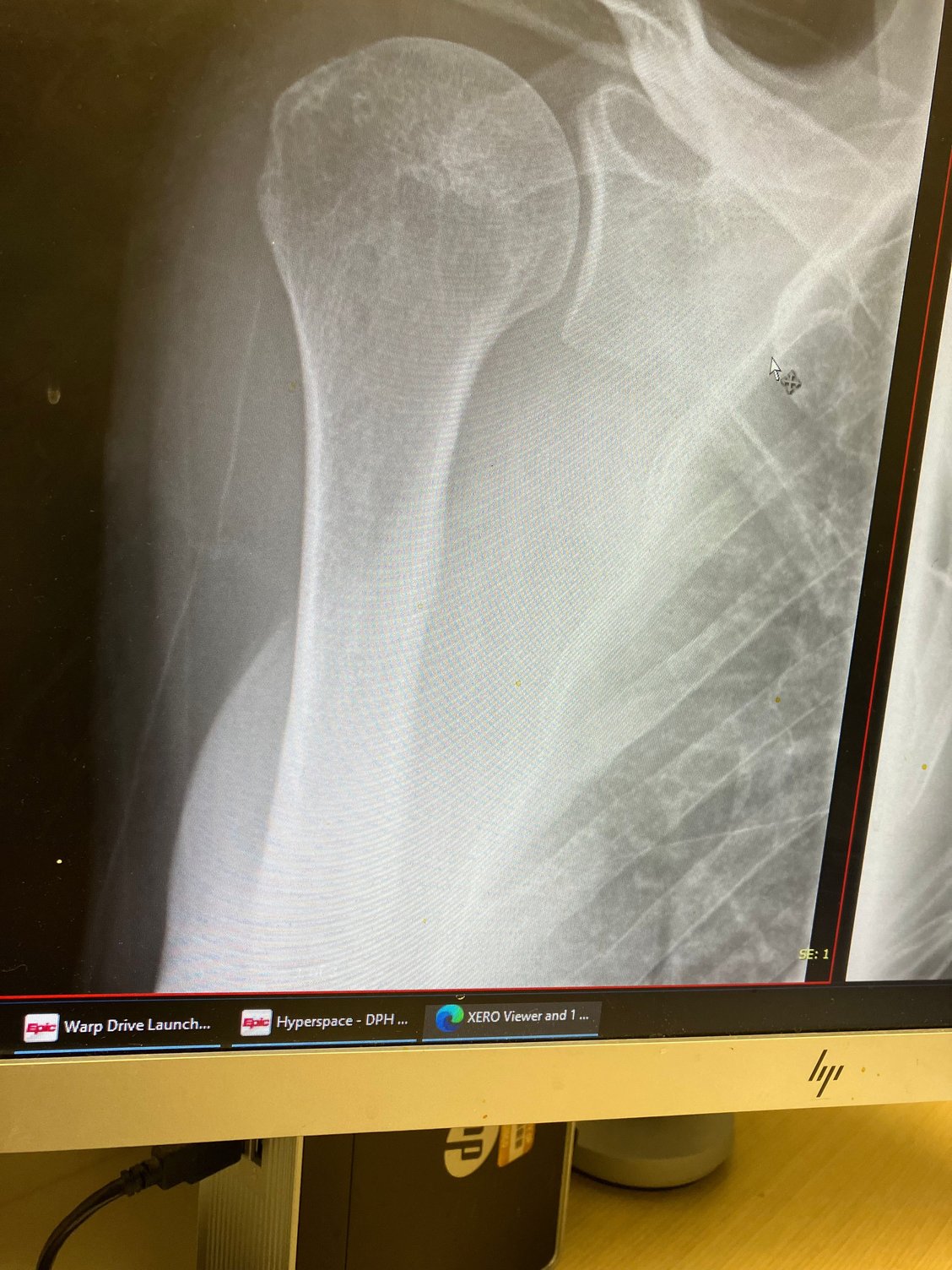 can someone who just had full hip surgery still use PreCheck lanes ...